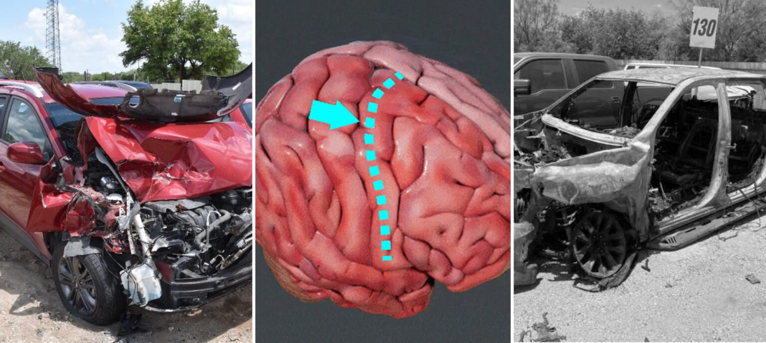 How Much Is a Good Settlement for Nerve Damage After a Car Accident ...